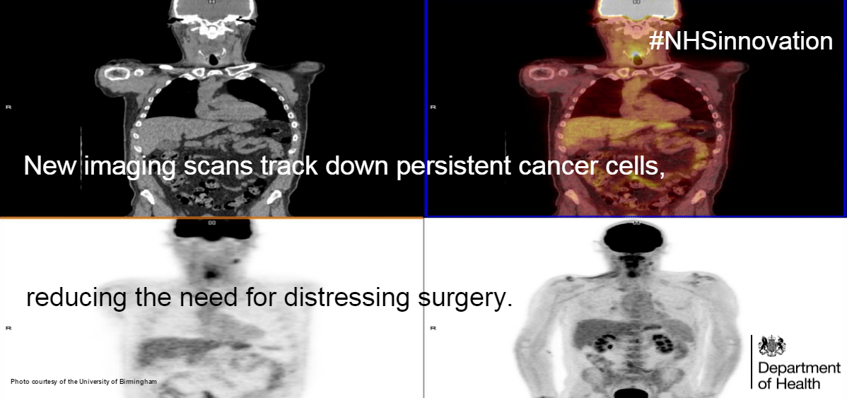 Cancer patients avoid distressing surgery thanks to innovative scans ...